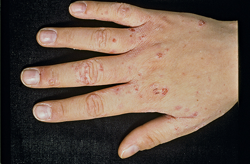 Vid klåda, tänk alltid på skabb! – Läkartidningen